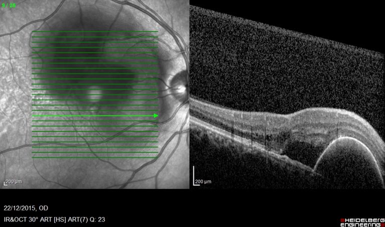 Dégénérescence maculaire liée à l’âge (DMLA) – Ophtalmologie Manosque ...