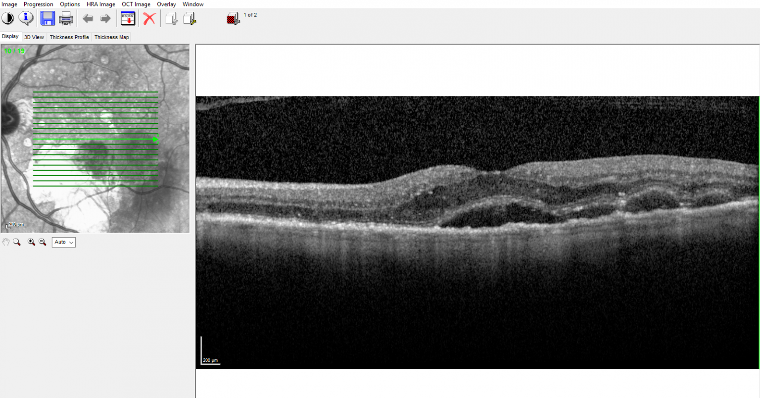Dégénérescence maculaire liée à l’âge (DMLA) – Ophtalmologie Manosque ...
